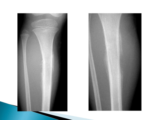 Radiology pediatric bone tumors | PPT