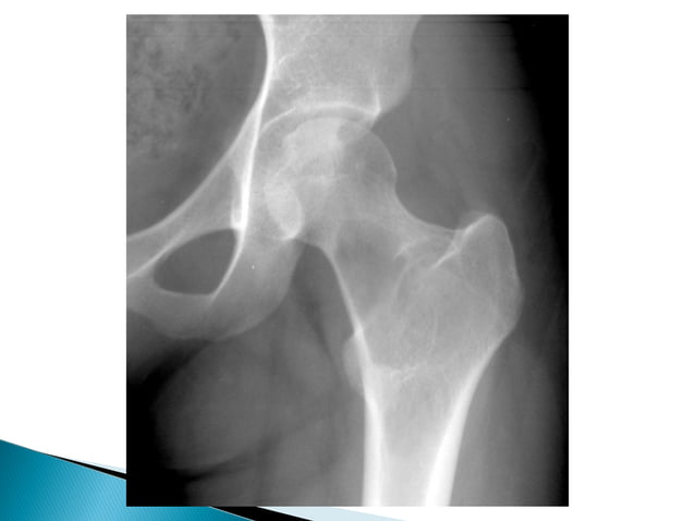 Radiology pediatric bone tumors | PPT