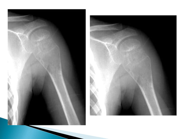 Radiology pediatric bone tumors | PPT