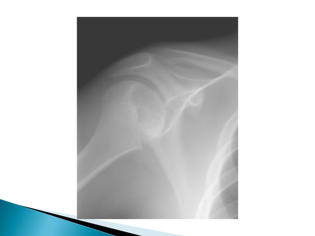 Radiology pediatric bone tumors | PPT