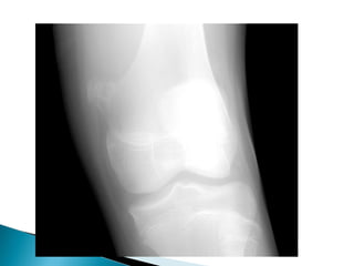 Radiology pediatric bone tumors | PPT