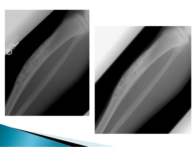 Radiology pediatric bone tumors