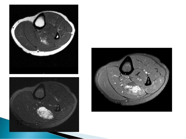 Radiology pediatric bone tumors