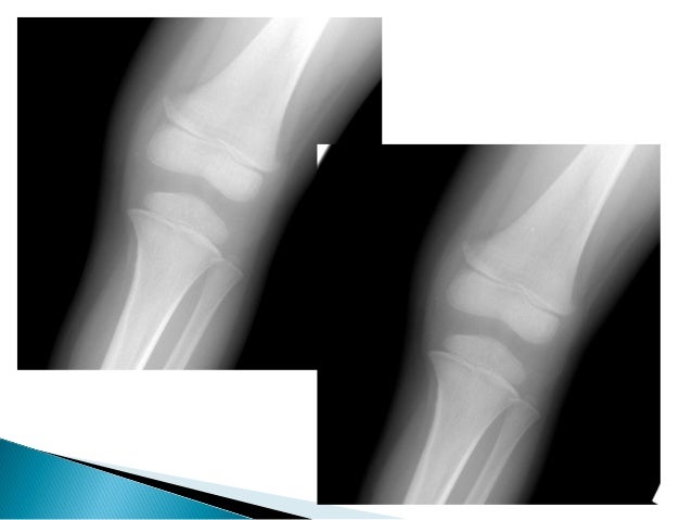Radiology pediatric bone tumors