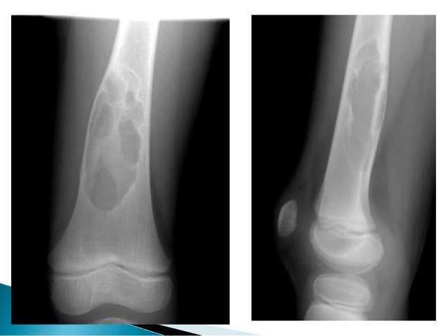 Radiology pediatric bone tumors