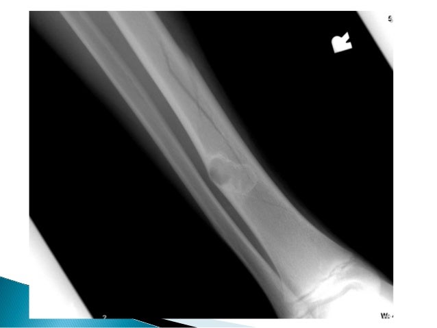 Radiology pediatric bone tumors