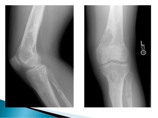 Radiology pediatric bone tumors