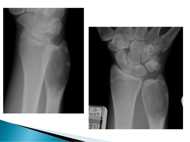 Radiology pediatric bone tumors