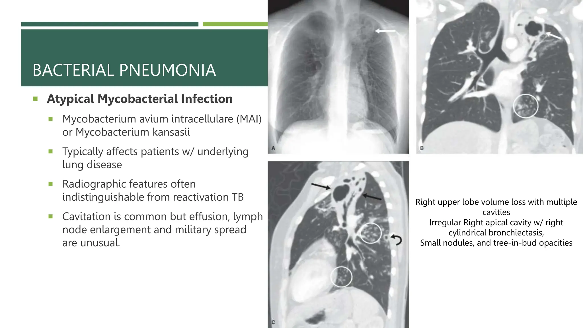Radiology Pulmonary Infections_Two.pptx | Lung and Respiratory Health ...