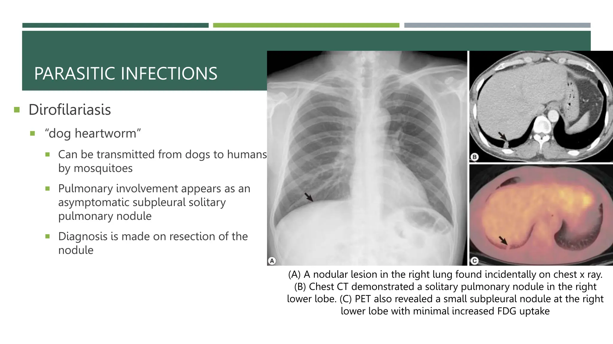 Radiology Pulmonary Infections_Two.pptx | Lung and Respiratory Health ...