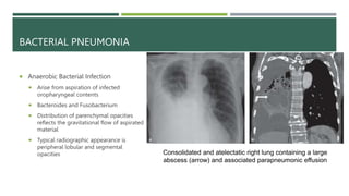 Radiology Pulmonary Infections_Two.pptx | Lung and Respiratory Health ...
