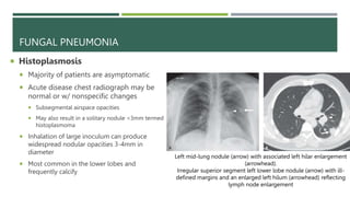 Radiology Pulmonary Infections_Two.pptx | Lung and Respiratory Health ...
