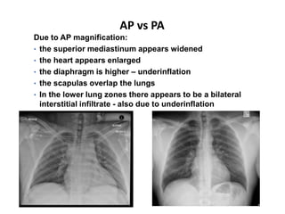 Radiology respiratory new.ppt