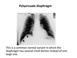 Radiology respiratory new.ppt