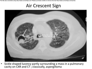 Classical radiology signs by shah zeb.pdf