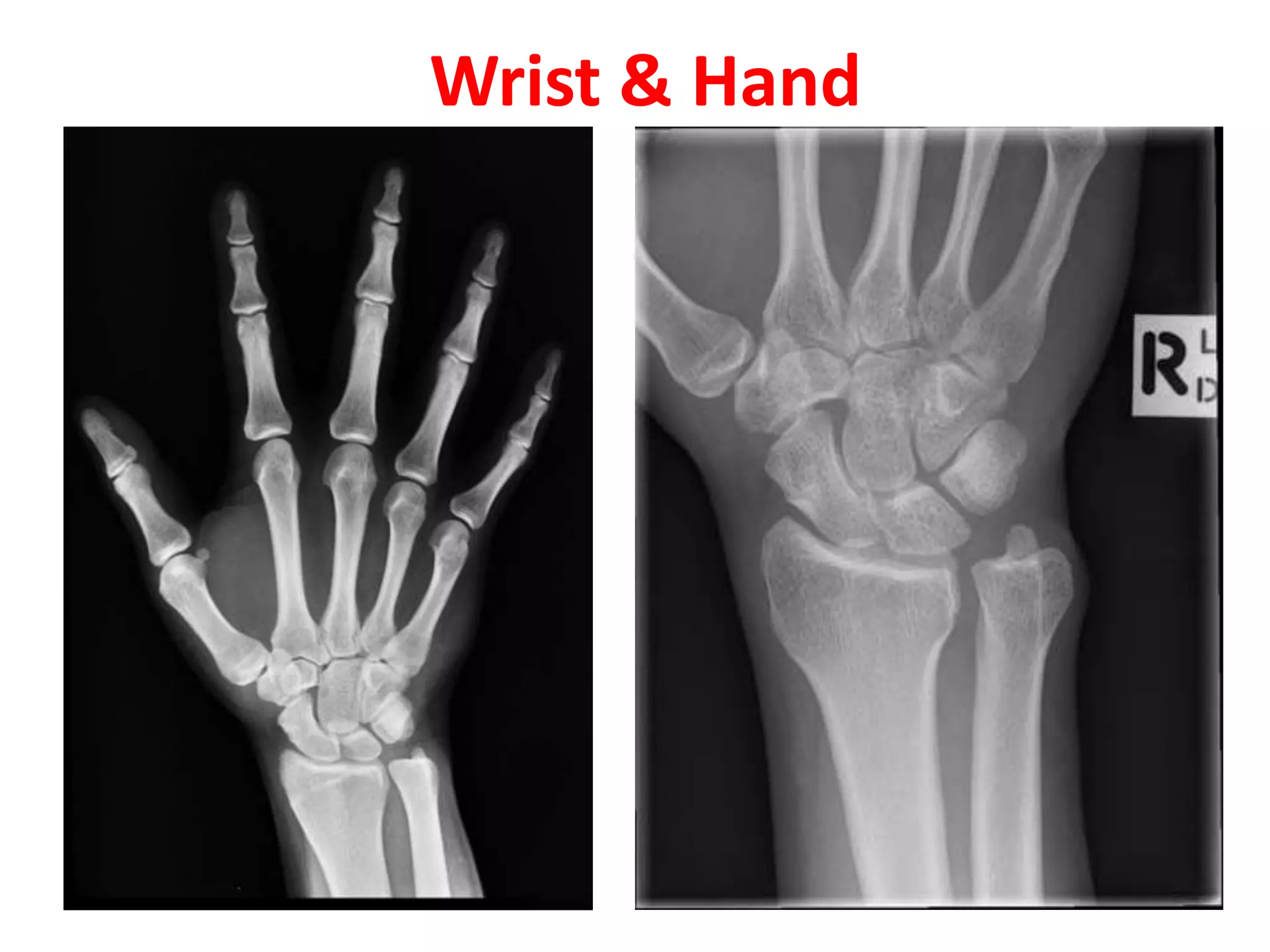 Radiology upper limb | PPTX