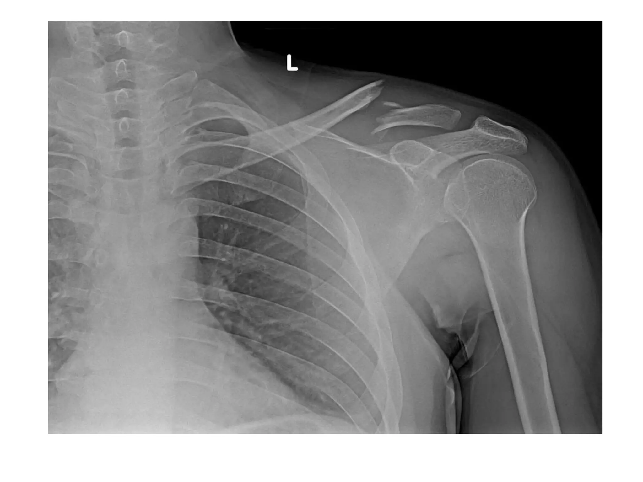 Radiology upper limb | PPTX