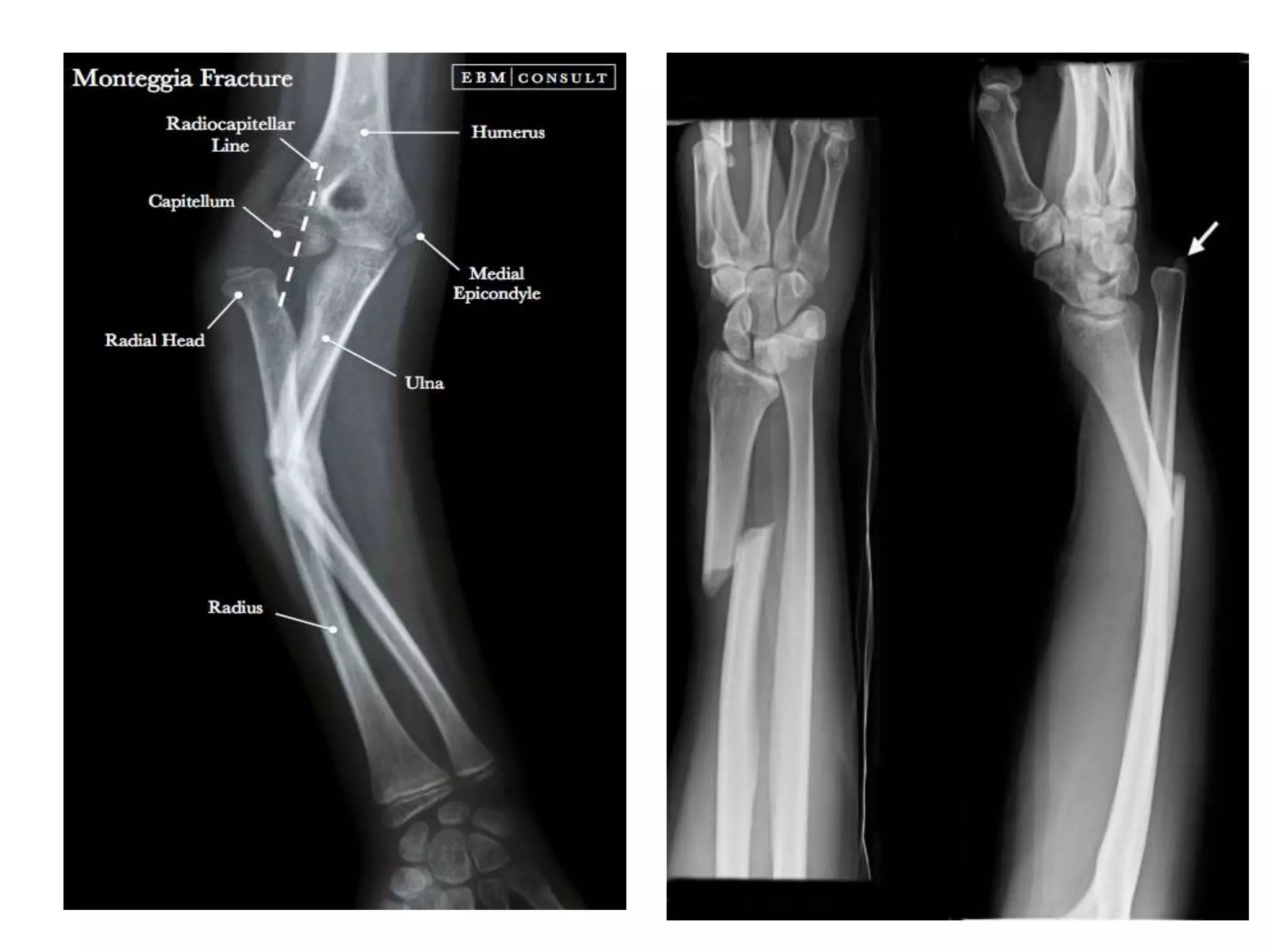 Radiology upper limb | PPTX