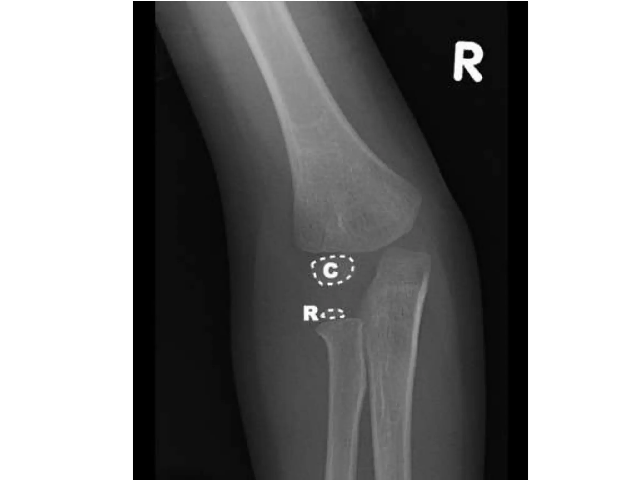 Radiology upper limb | PPTX