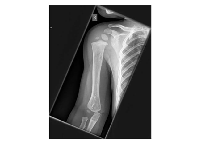 Radiology upper limb | PPTX