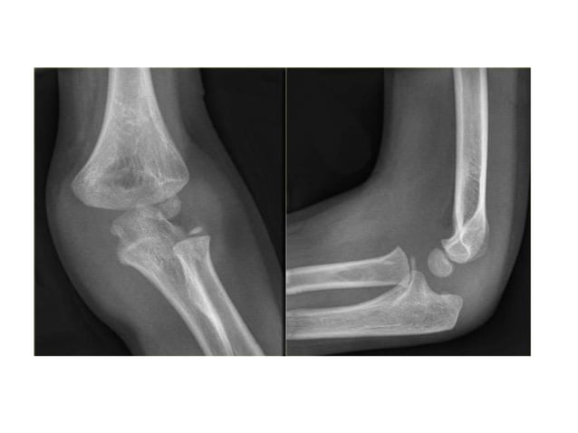 Radiology upper limb | PPTX