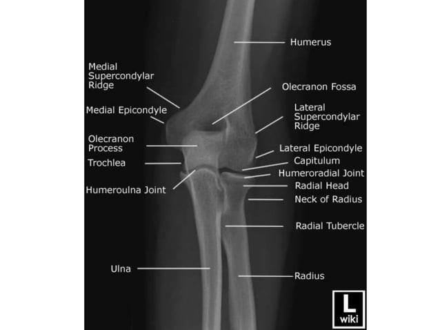 Radiology upper limb | PPT