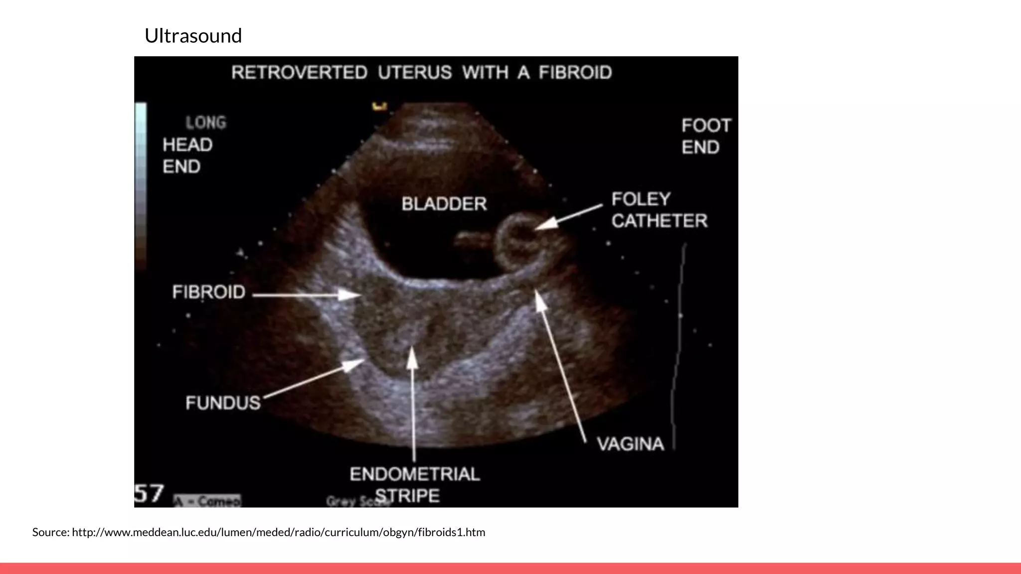 Diagnostic Imaging in Uterine fibroids | POTX