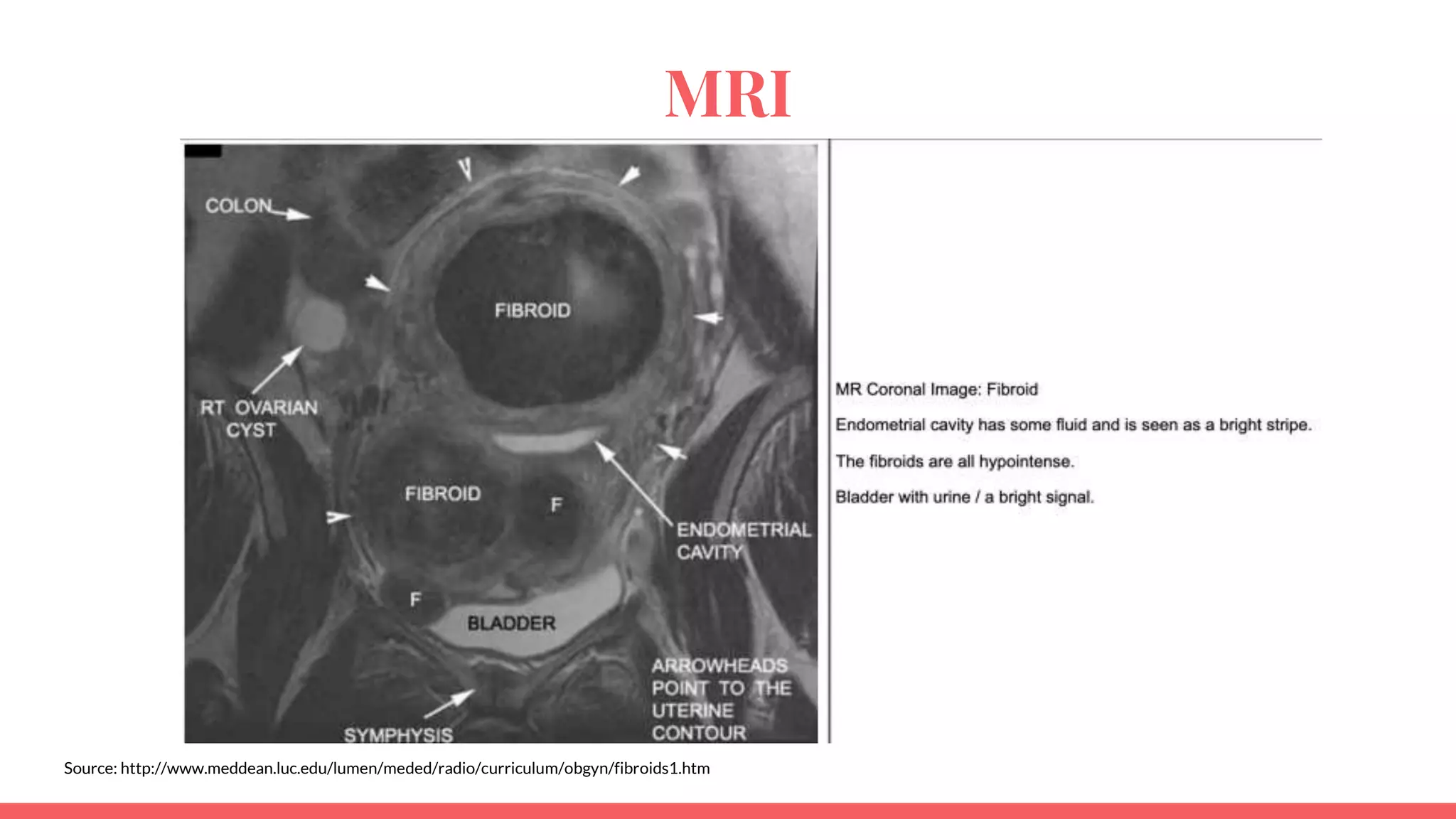 Diagnostic Imaging in Uterine fibroids | POTX