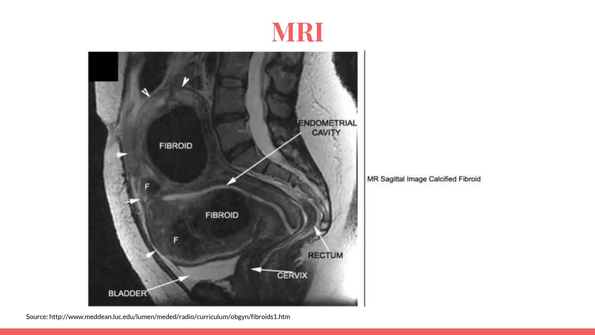 Diagnostic Imaging in Uterine fibroids | POTX
