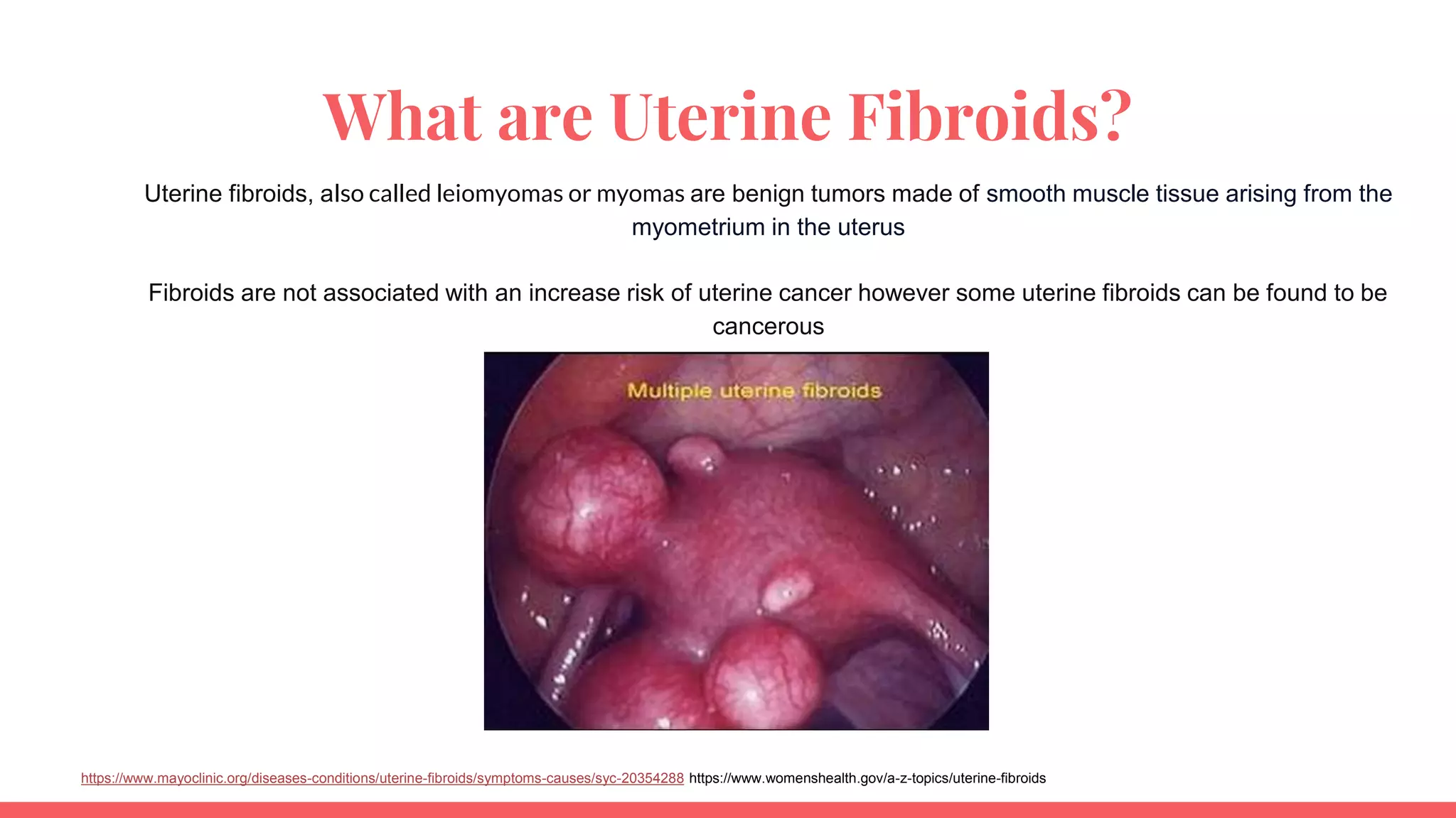 Diagnostic Imaging In Uterine Fibroids Ppt