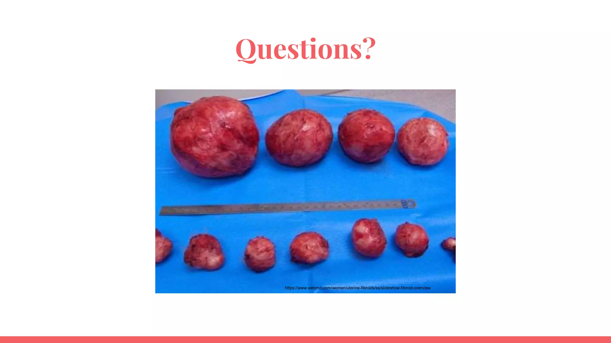 Diagnostic Imaging in Uterine fibroids | POTX