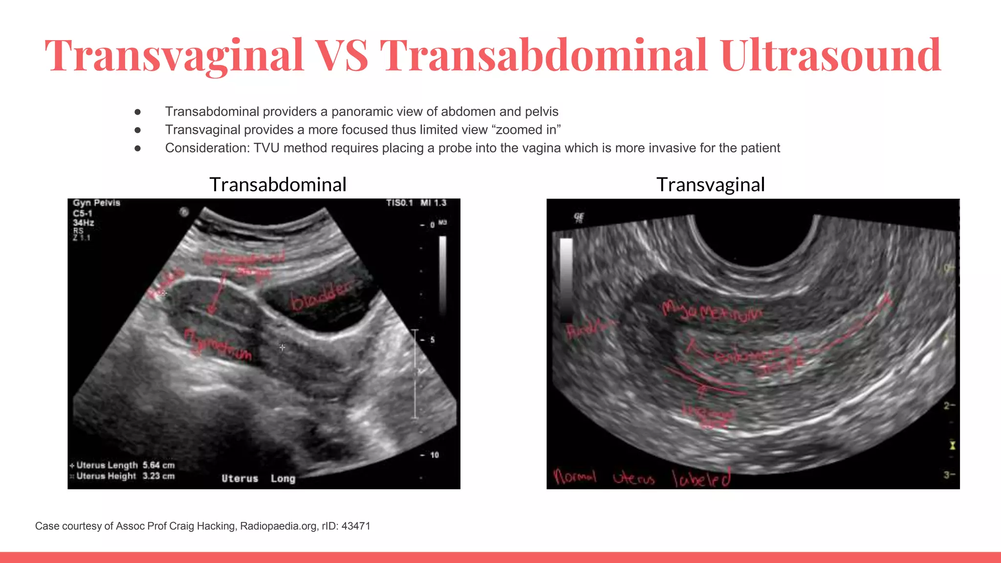 Diagnostic Imaging in Uterine fibroids | POTX