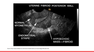 Diagnostic Imaging in Uterine fibroids | POTX