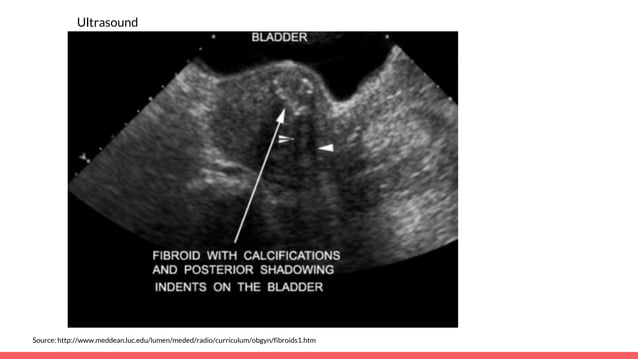 Diagnostic Imaging in Uterine fibroids | POTX | Pregnancy ...