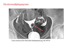 Diagnostic Imaging in Uterine fibroids | POTX