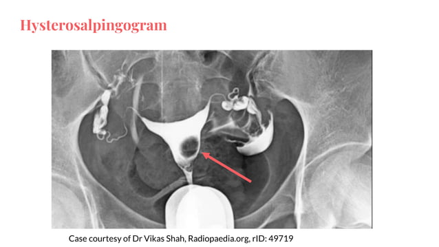 Diagnostic Imaging in Uterine fibroids | POTX | Pregnancy | Reproductive Health
