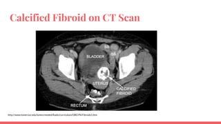 Diagnostic Imaging in Uterine fibroids | POTX