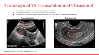 Diagnostic Imaging in Uterine fibroids | POTX