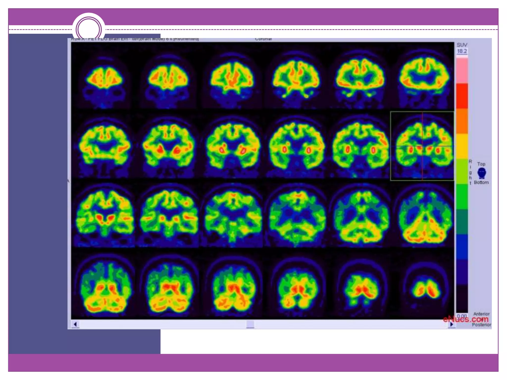 Radionucleide imaging of the brain | PPTX