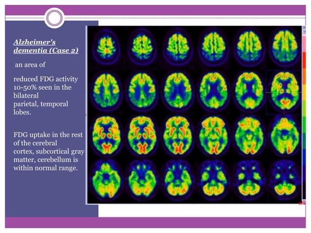 Radionucleide imaging of the brain | PPTX