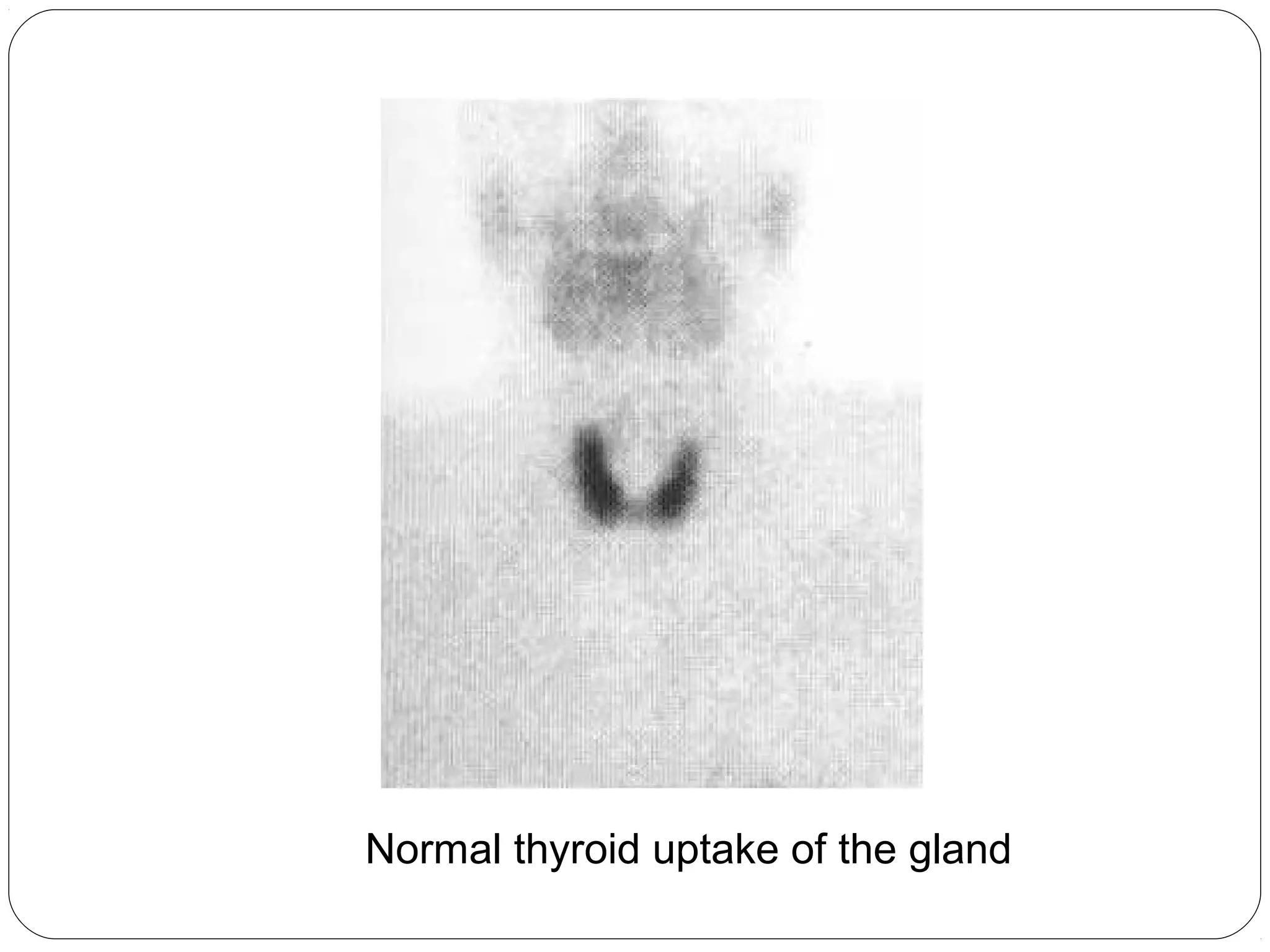 Radionuclide imaging thyroid & parathyroid | PPT