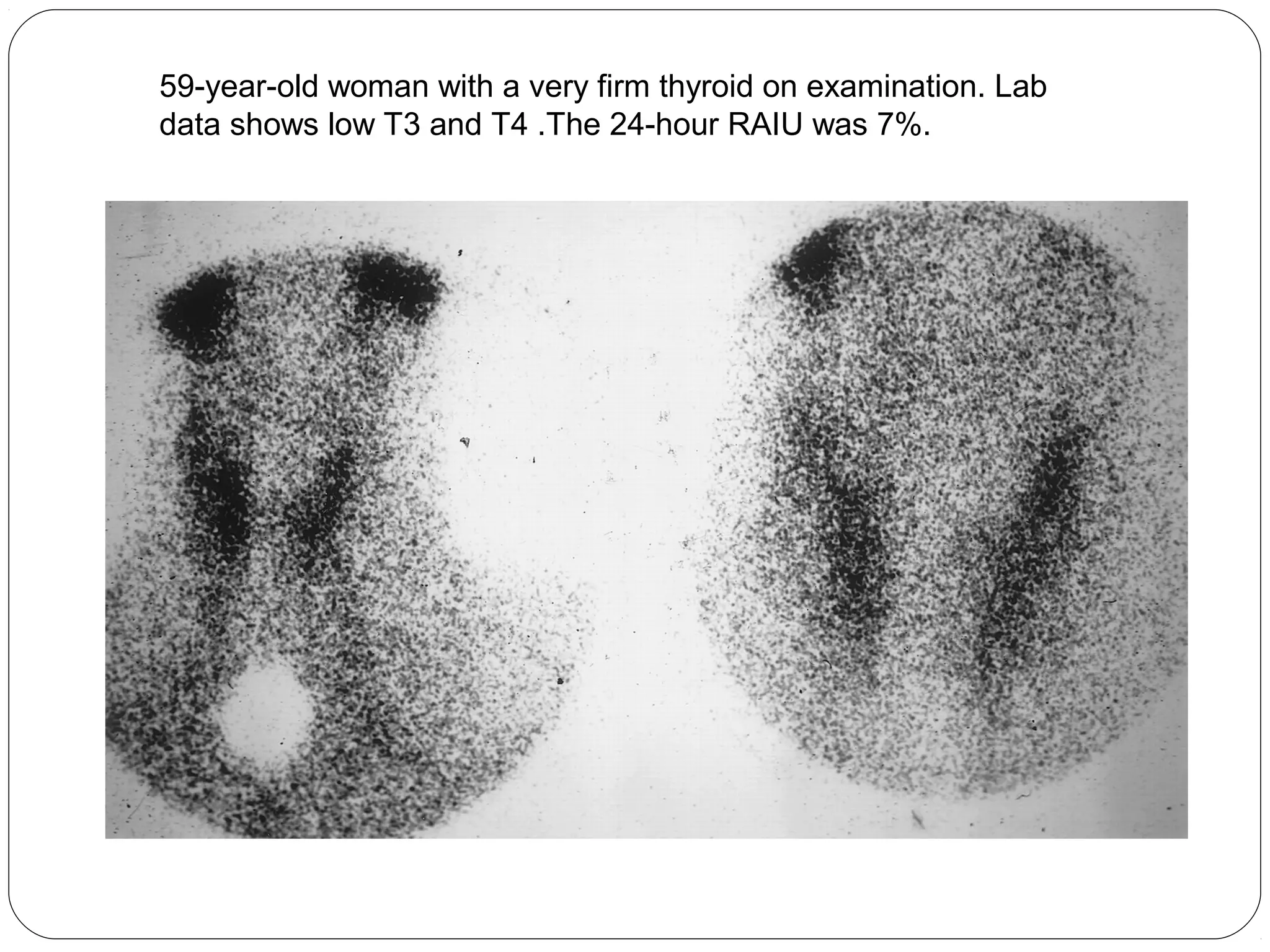Radionuclide imaging thyroid & parathyroid | PPT