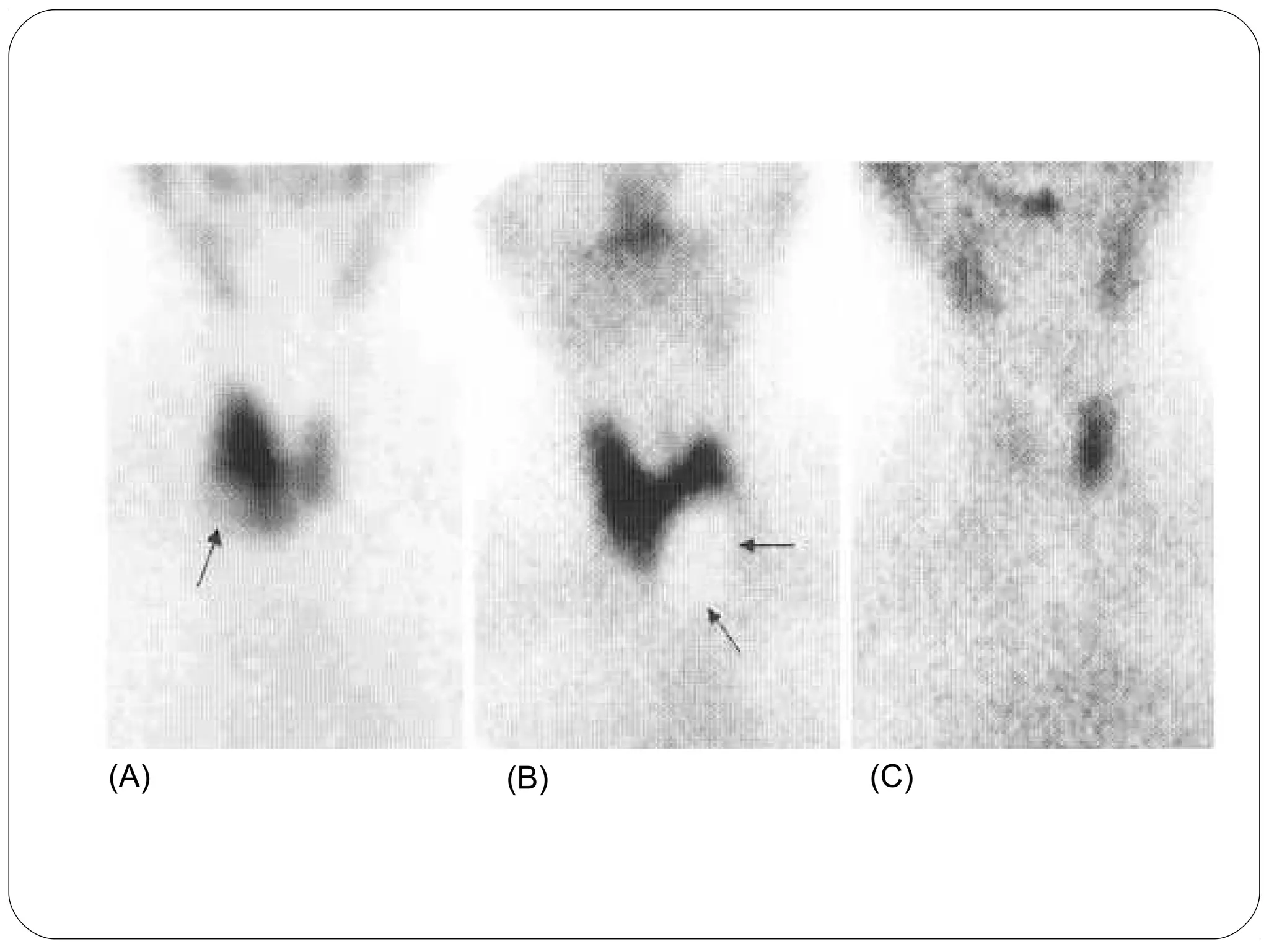 Radionuclide imaging thyroid & parathyroid | PPT