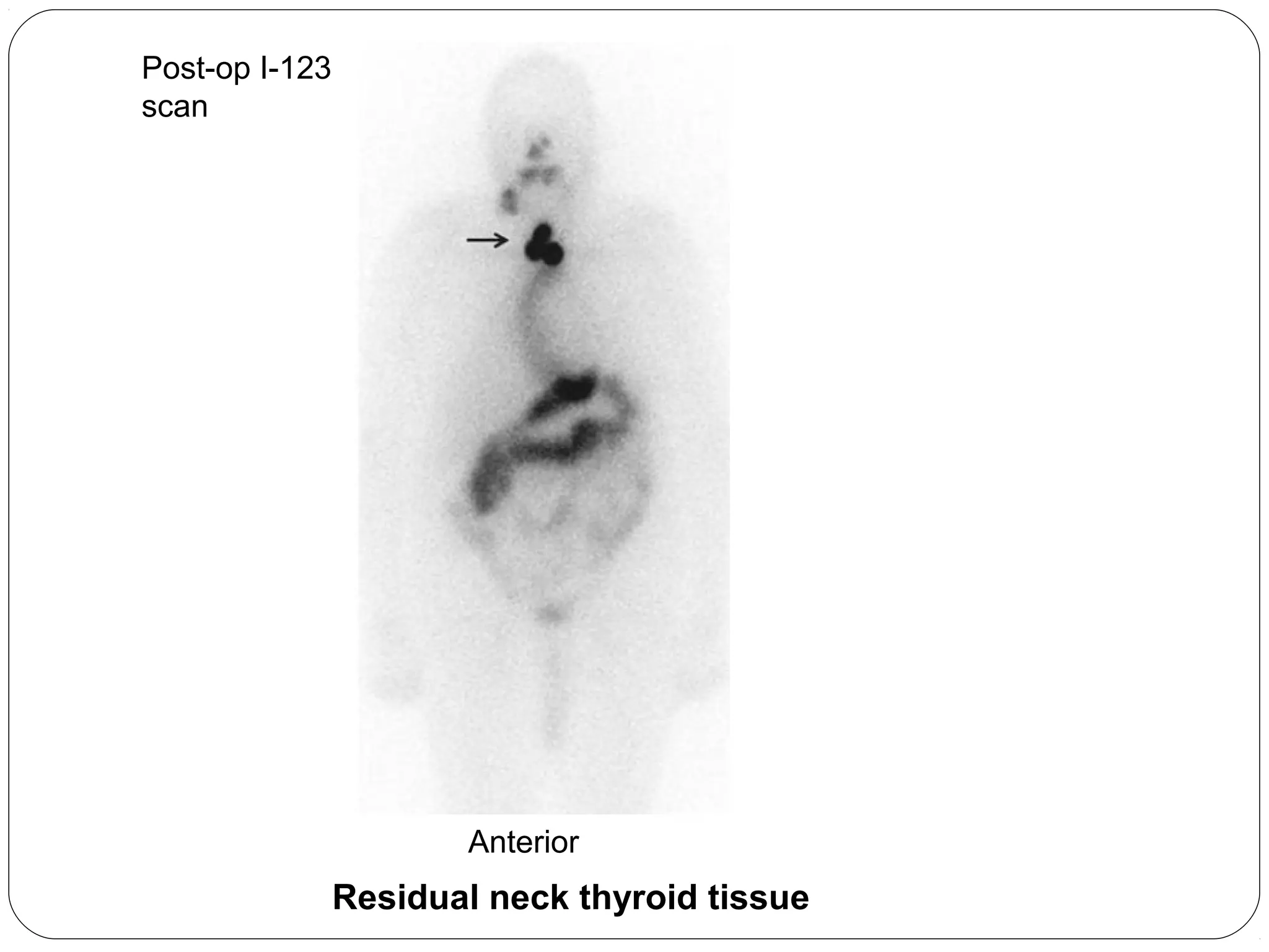 Radionuclide imaging thyroid & parathyroid | PPT