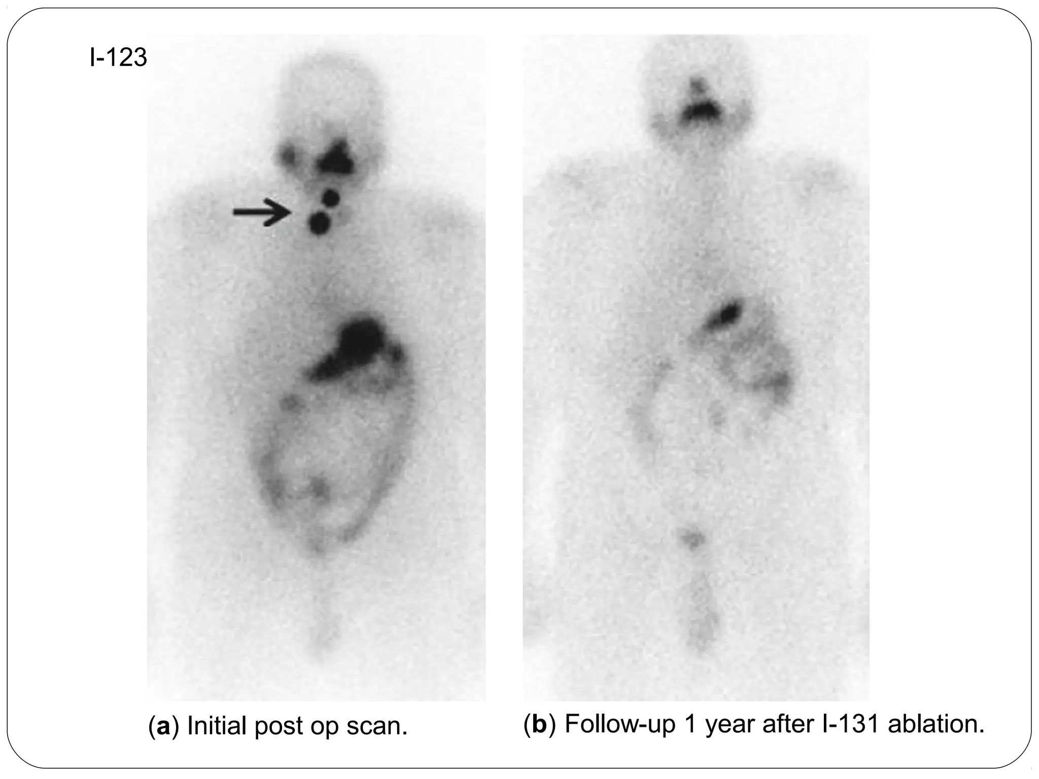 Radionuclide imaging thyroid & parathyroid | PPT