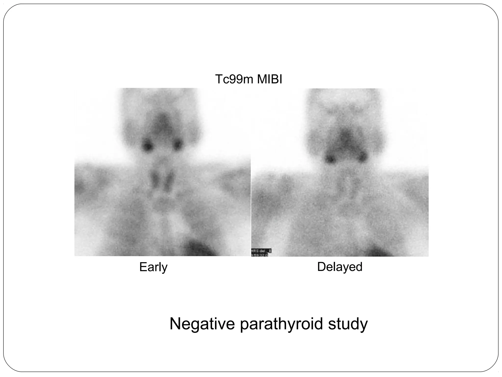 Radionuclide imaging thyroid & parathyroid | PPT
