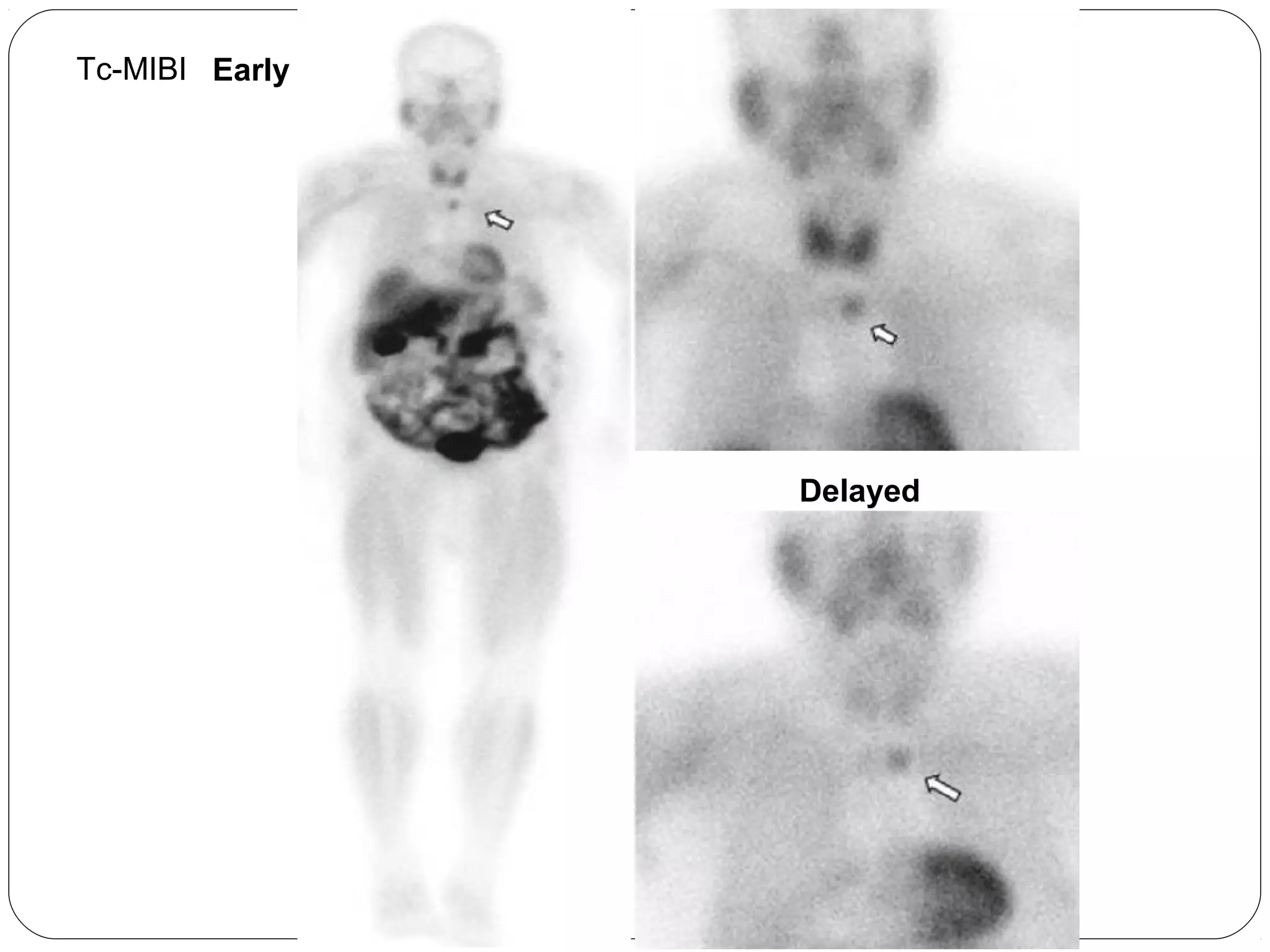 Radionuclide imaging thyroid & parathyroid | PPT