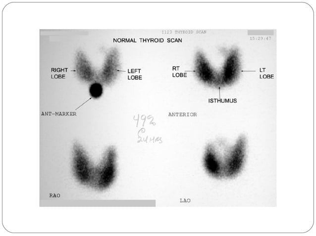 Radionuclide imaging thyroid & parathyroid | PPT