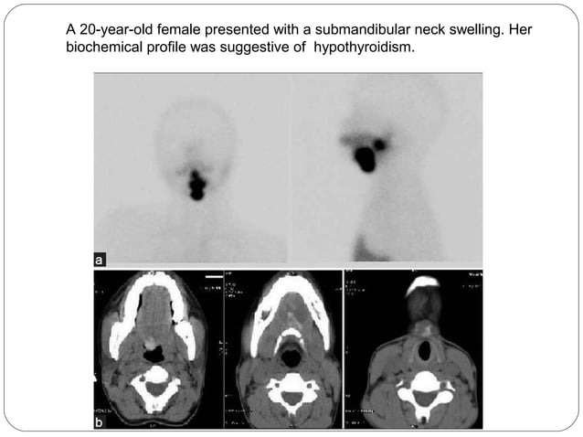 Radionuclide imaging thyroid & parathyroid | PPT