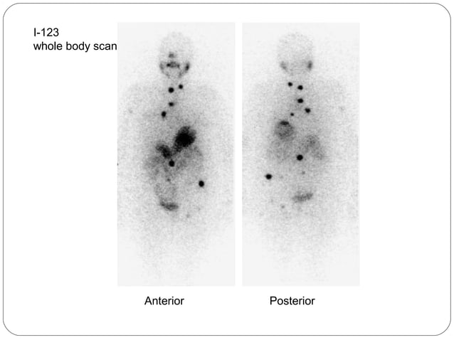 Radionuclide imaging thyroid & parathyroid | PPT